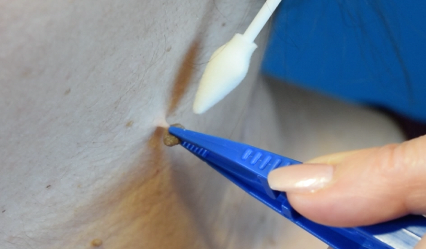 How to Get Rid of Skin Tags at Home | Shop Skin Clinic